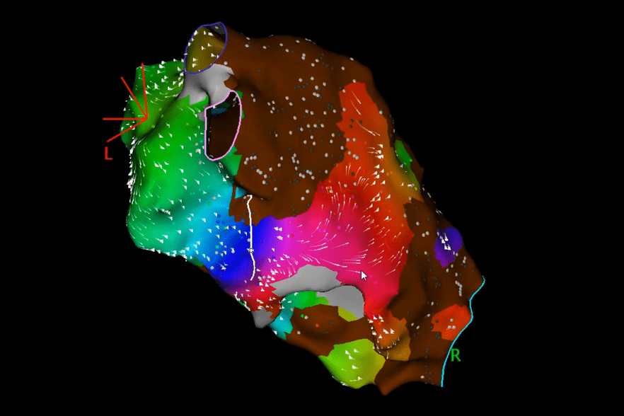 Най-модерната система за 3D картографиране на сложни сърдечни артимии ...